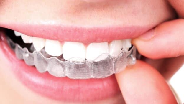 Wearing Invisalign Aligners: Expert Instructions & Tips | House of ...